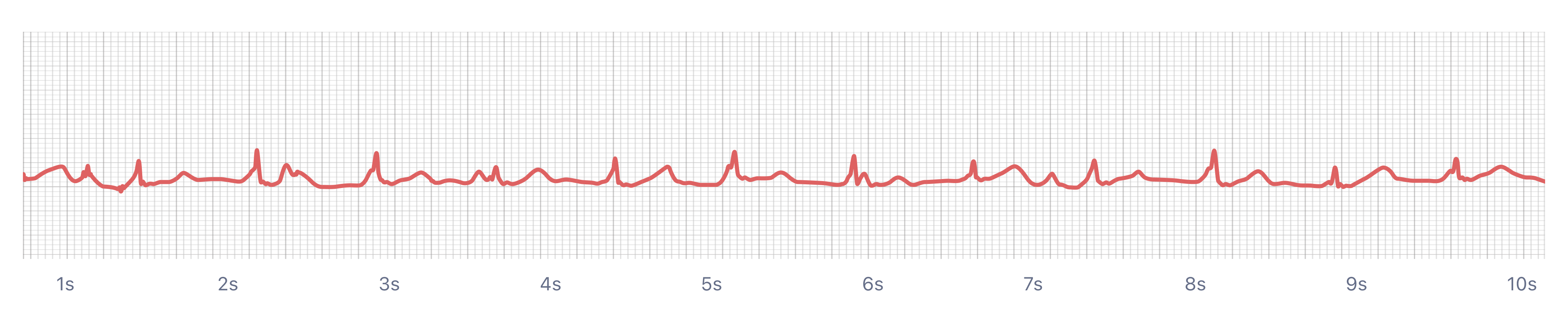 What Complete Heart Block Looks Like on Your Watch ECG | Qaly